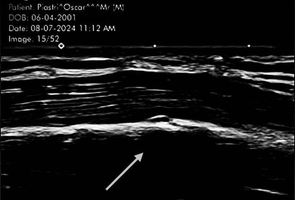 'Very special talent' Piastri reveals 'first broken bone' in F1